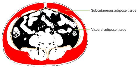 Cross Sectional Abdominal Computerized Tomography Ct Image Of Download Scientific Diagram