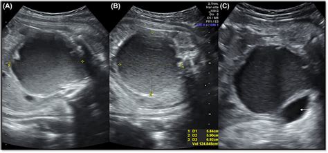 Obstetric Ultrasound A And B Sagittal And Axial Views Of The Fetal