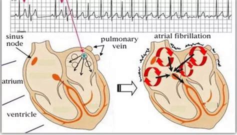 What Is Svt Arrhythmia