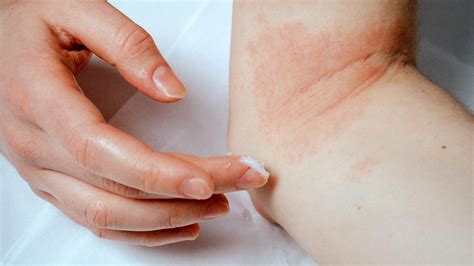 Meta Analysis Points To Most Effective Topical Treatments For Atopic