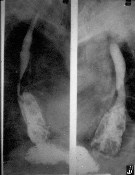 Abdomen Esophagus Scleroderma Radioogle