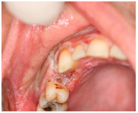 Nicotinic Stomatitis