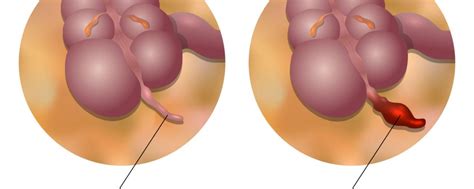 Appendix Removal Surgery