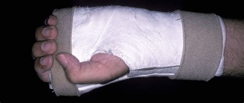 Mp Extension Blocking Splint At Peggy Bergmann Blog