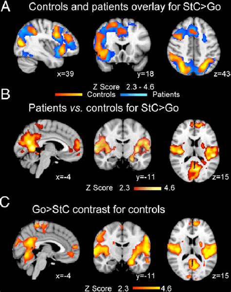 Abnormal Dmn Deactivation After Tbi A Overlay Of Brain Activation