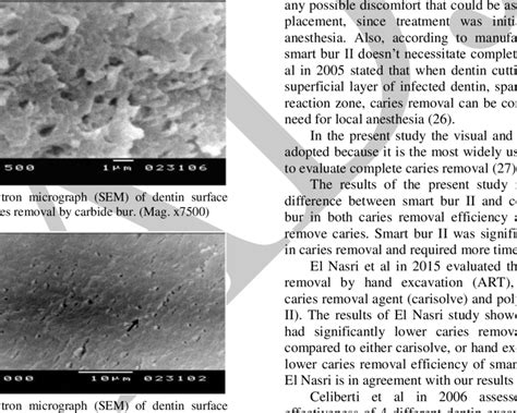 Scanning Electron Micrograph Sem Of Dentin Surface Following Caries Download Scientific