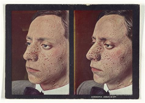 Adenoma Images Free Photos Png Stickers Wallpapers And Backgrounds