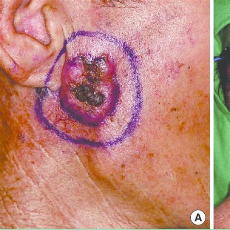 Surgical Procedure A Preoperative Photo Designed Excisional Margin Download Scientific