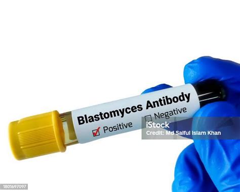 Blastomcyes Antibody Testing Blastomycosis Is An Infection Caused By A Fungus Called Blastomyces