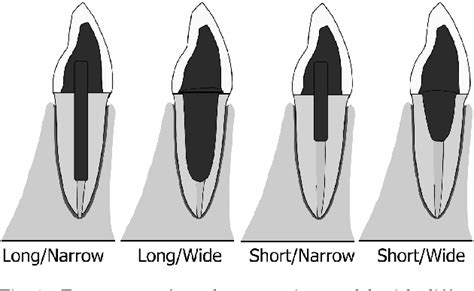 Table 1 From Stress Analysis Of Endodontically Treated Anterior Teeth