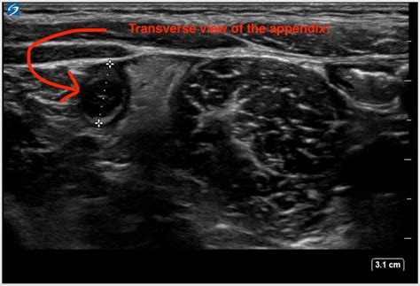 Pem Pocus Series Pediatric Appendicitis