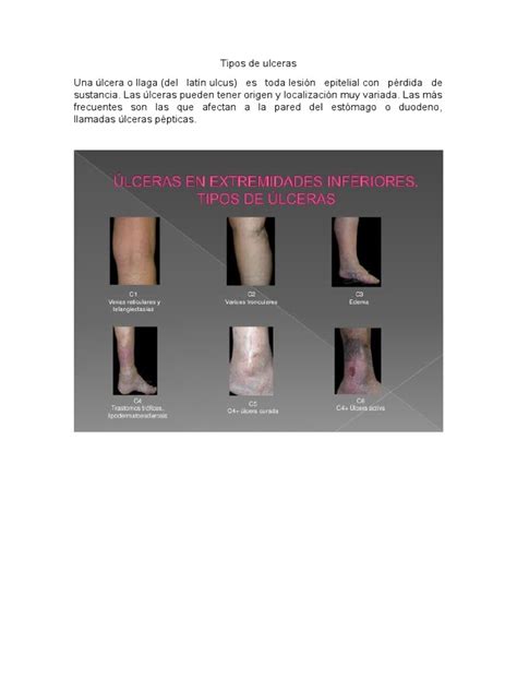 Tipos De Ulceras Pdf