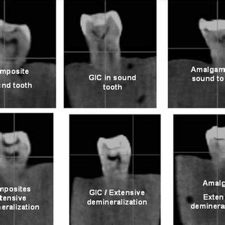 Amalgam Restoration X Ray Amalgam Restoration Grey Filling