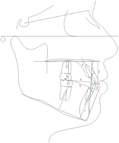 Fig Unusual Cephalometric Variables 1 Mx1pp 2 Mx1 Aperp 3