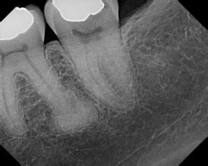 Hypercementosis Dr Gs Toothpix
