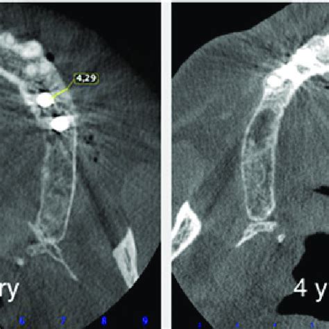 A Schematic Diagram Of Bone Splitting Technique B‑d Clinical