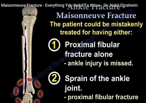 Maisonneuve Fracture —