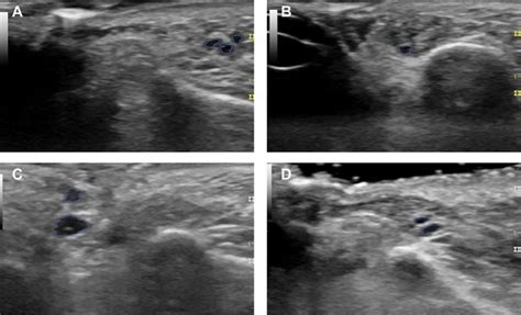High Resolution Ultrasound High Resolution Ultrasound Of Schwannoma Of