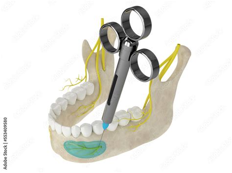 Mandibular Arch With Incisive Nerve Block Stock Illustration Adobe Stock
