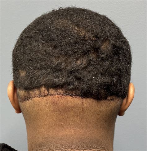 Scalp Roll Excision One Day Postop Bacsk View Dr Barry Eppley Explore