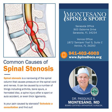 Common Causes Of Spinal Stenosis Spine Docs
