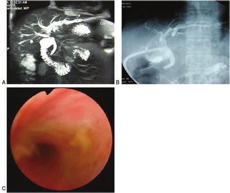Cholangiography Before And After Stomach Flap Repair A Magnetic