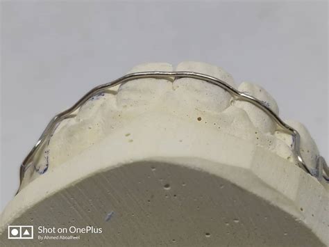 Fitted Labial Bow Ortho Design Laboratory