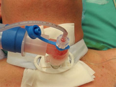 Cricothyrotomy For Elective Difficult Airway Management Iowa Head And