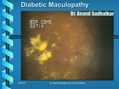 Diabetic Maculopathy1 Gos2 Ppt