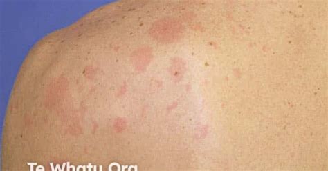 Phytophotodermatitis Image