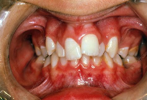 View Of Malaligned Teeth Before Braces Were Fitted Stock Image M780 0255 Science Photo Library