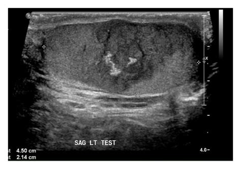 Sagittal Sonogram Of The Left Testis Demonstrates Testicular Mass With Download Scientific