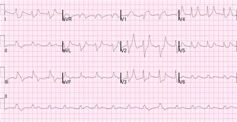 Dr Smiths Ecg Blog Hyperkalemia And St Segment Elevation Post 1