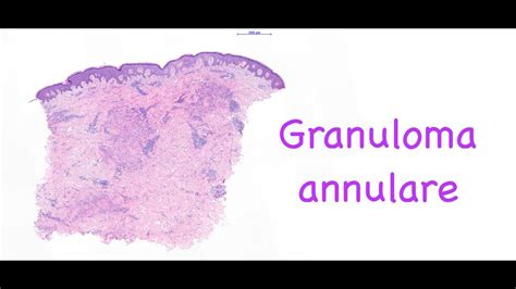 What Is Granuloma Annulare Associated With Trust The Answer