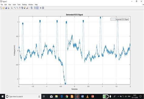 Qrs Complex Detection Using Wavelet Transform 2signal Processing It