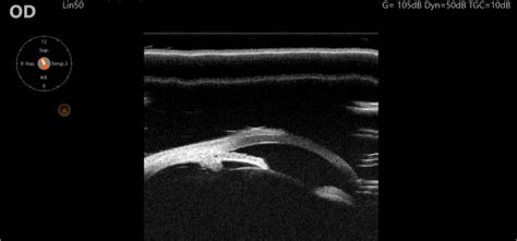 Ultrasound Biomicroscopy Showing Superficial Ossn Pre Operatively