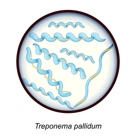Congenital Syphilis Over 3 Royalty Free Licensable Stock Vectors