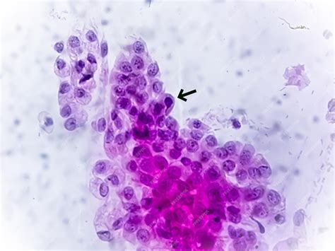 Premium Photo Microscopic View Of Trichomonas Vaginalis In Pap Smear With Few Acute