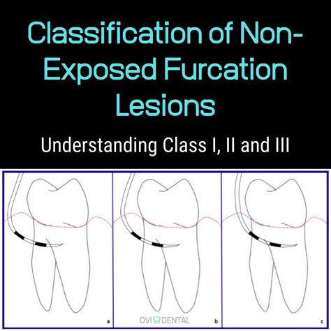 Ovidental 🚫 Classification Of Non Exposed Furcation Lesions