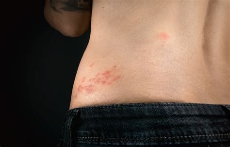 I Have Symptoms Of Sti After Visiting Sex Worker Dr Zoe Answers Your