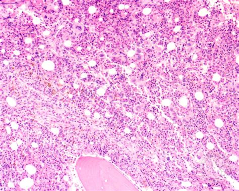 Hiv Related Plasmacytosis 1
