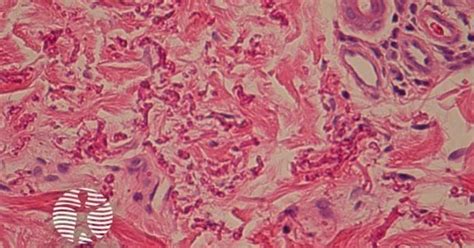 Pseudoxanthoma Elasticum Pathology Image