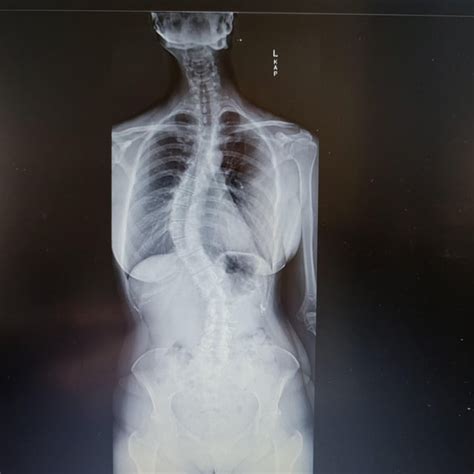 Post Op Recovery Needs Rscoliosis