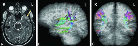 The Arcuate Fasciculus And Language Development In A Cohort Of