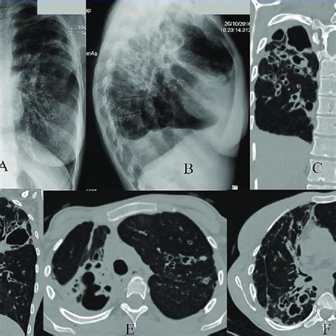Basic Morphologic Types Of Bronchiectasis Recognized On Ct Axial Ct