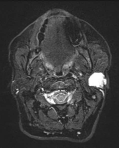 Adenoma Pleomorfico Bruto