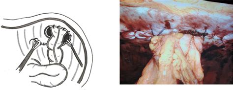 The Fascial Defect Of The Hernia Was Closed Using Barbed V Loc