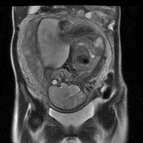 A Cystic Mass Of 15 2 X 6 8 Cm With Fluid Level Is Seen Outside The Download Scientific Diagram