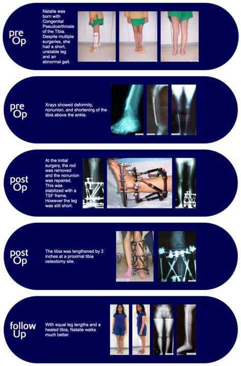 Limb Salvage Reconstruction Of Congenital Pseudoarthrosis Limb Lengthening