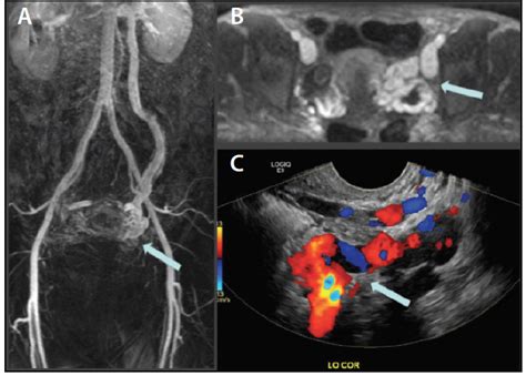 Varicose Veins Pelvic Area